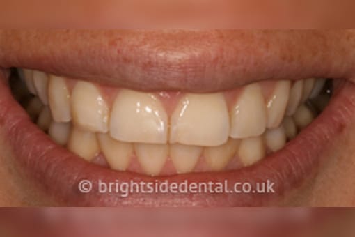 Dental Smile Gallery | Brightside Dental