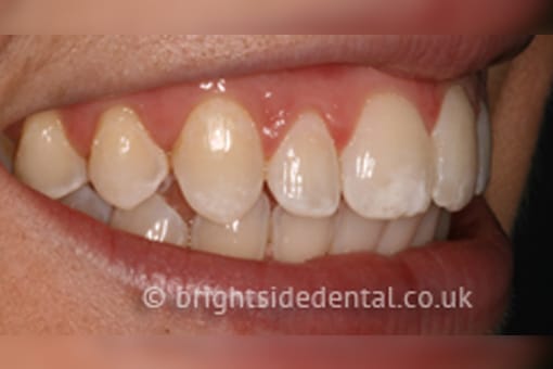 Dental Smile Gallery | Brightside Dental