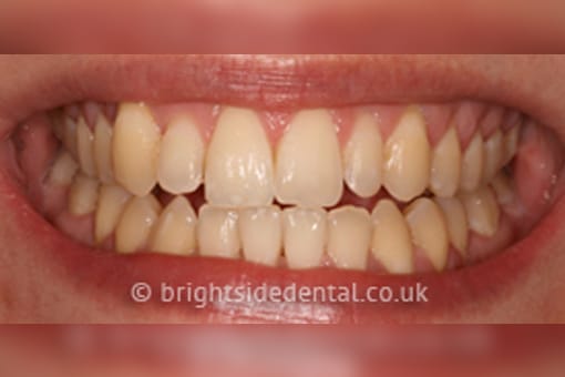 Dental Smile Gallery | Brightside Dental